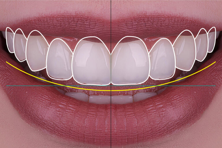 Smile Makeover Process | North Creek Dental Care